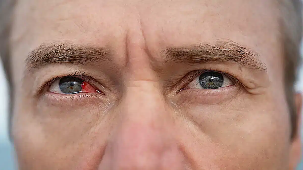 Exploring the Types of Eye Infections and Their Causes