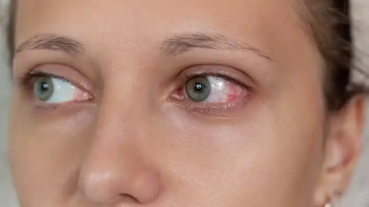 Understanding Uveitis and How it Affects the Eye