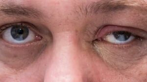 Does Pink Eye Cause Swelling? Understanding the Symptom
