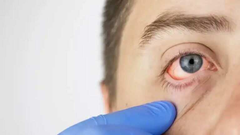 How Long Does Pink Eye Last? Understanding the Duration