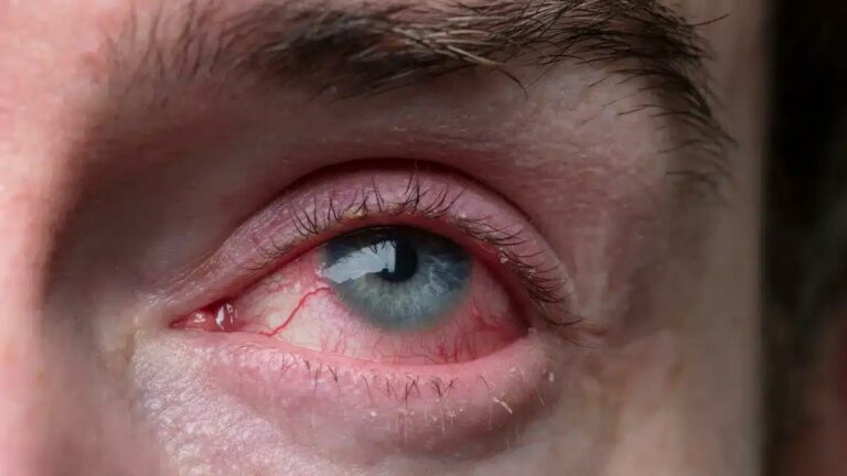 Is Pink Eye Dangerous? The Truth Revealed