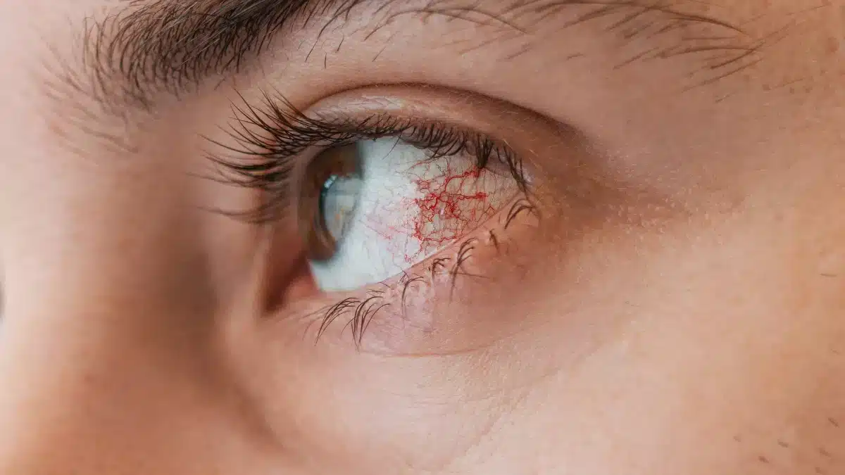 “Posterior Uveitis: Causes, Symptoms, Diagnosis, and Treatment Options