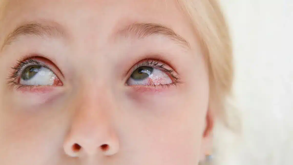 Viral Pink Eye Remedy Tips: From Natural to OTC Solutions