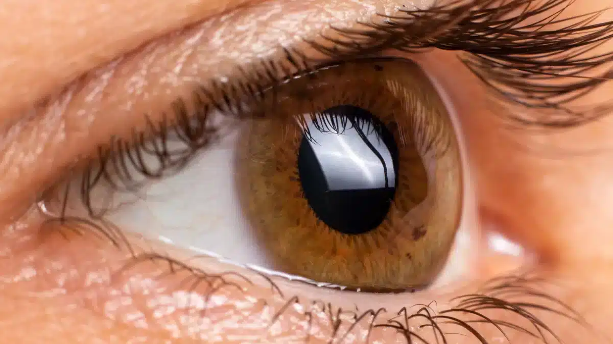 Marginal Keratitis: Symptoms, Causes, and Treatment Options