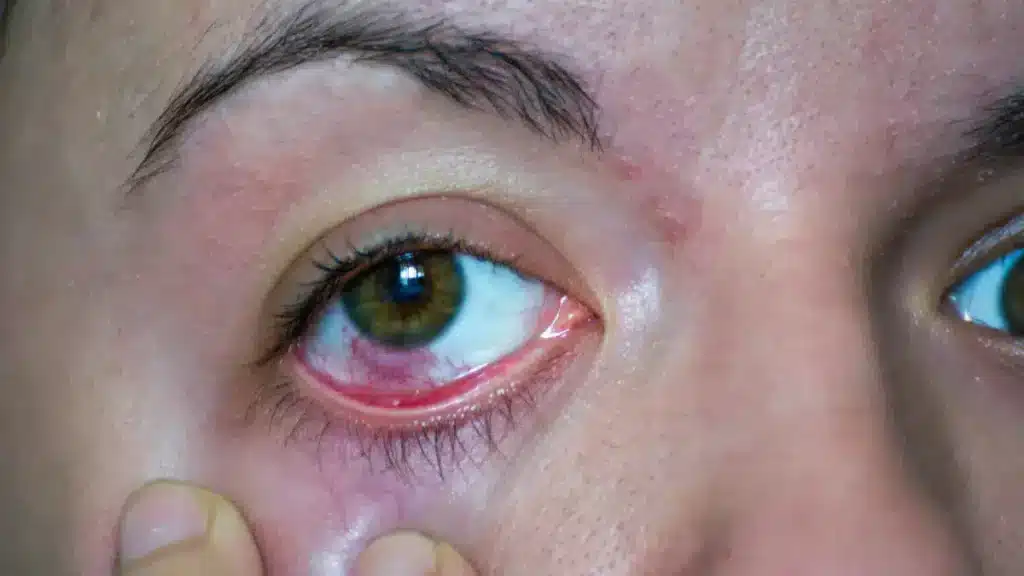Pink Eye vs Red Eye Explained: Know the Difference