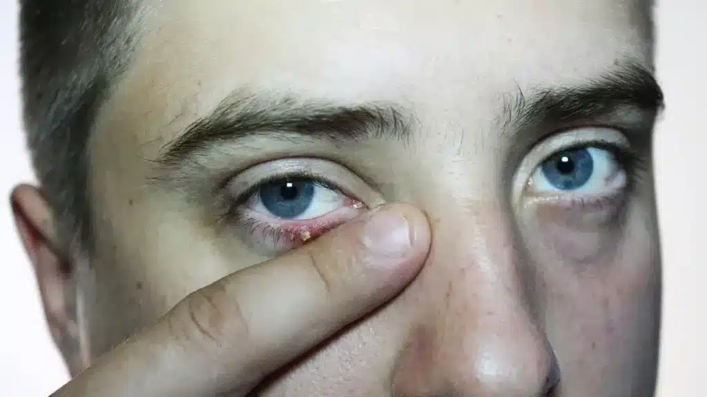 Everything About Discharge from Eye Allergies