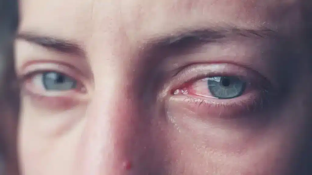 Understanding the treatment: watery eyes treatment