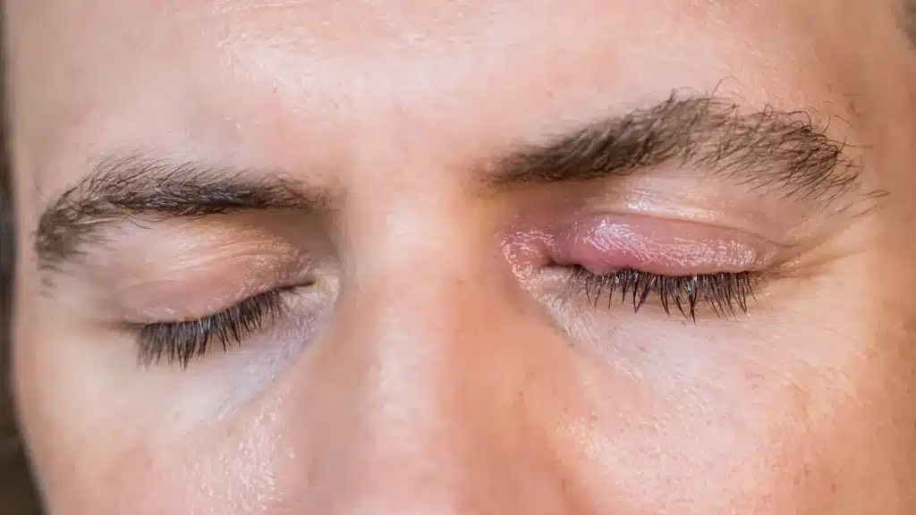 Swollen Eye: Causes, Symptoms, and Fast Relief Tips