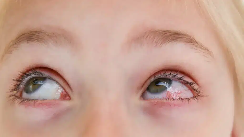 Green Eye Discharge: Unraveling Causes & Solutions