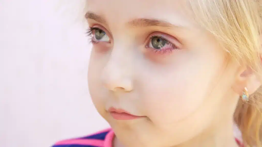 Explore the Causes and Treatment of Yellow Eye Discharge